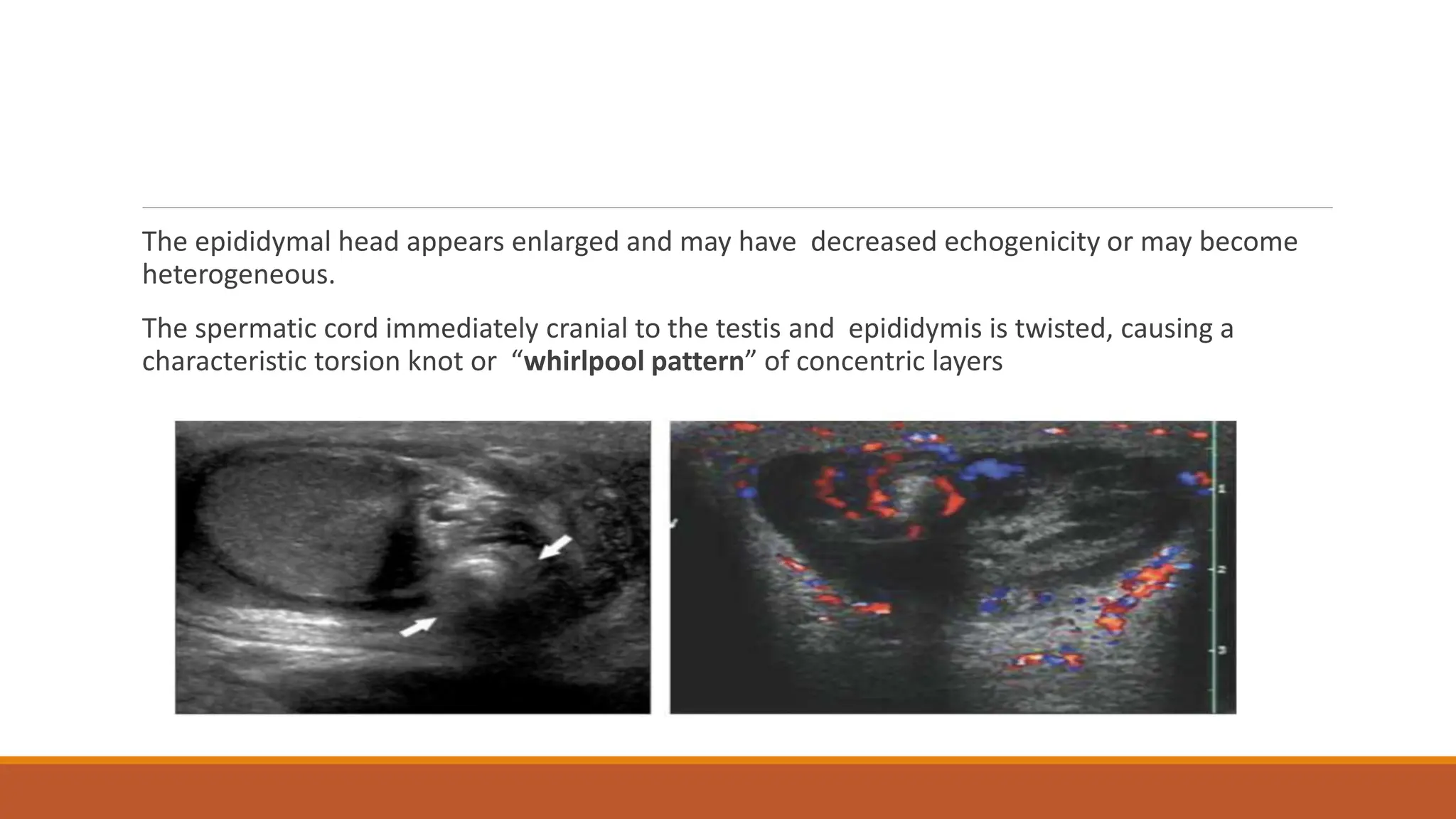 Testicular Torsion (Surgical emergency) .pptx