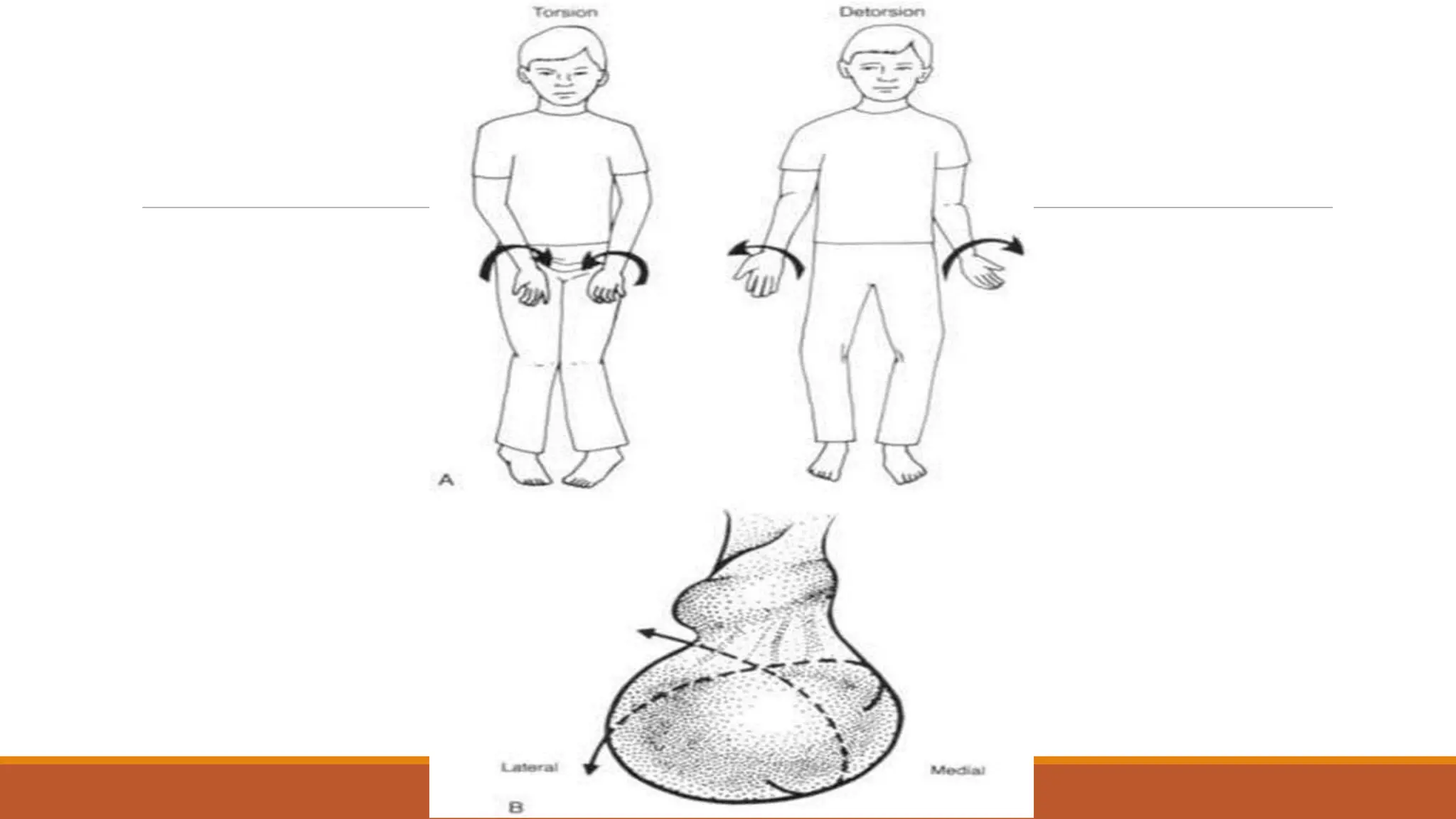 Testicular Torsion (Surgical emergency) .pptx