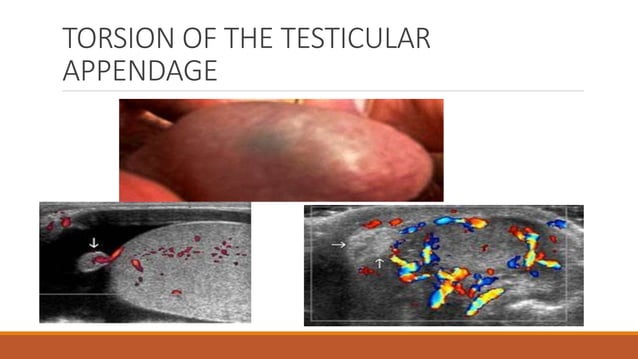 Testicular Torsion (Surgical emergency) .pptx | Infertility ...