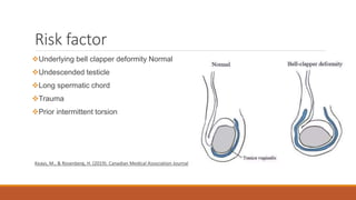Testicular Torsion (Surgical emergency) .pptx