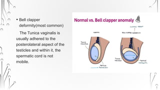 Testicular torsion and Epididymo-orchitis.pptx