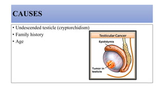 Testicular Torsion & Testicular cancer.pptx
