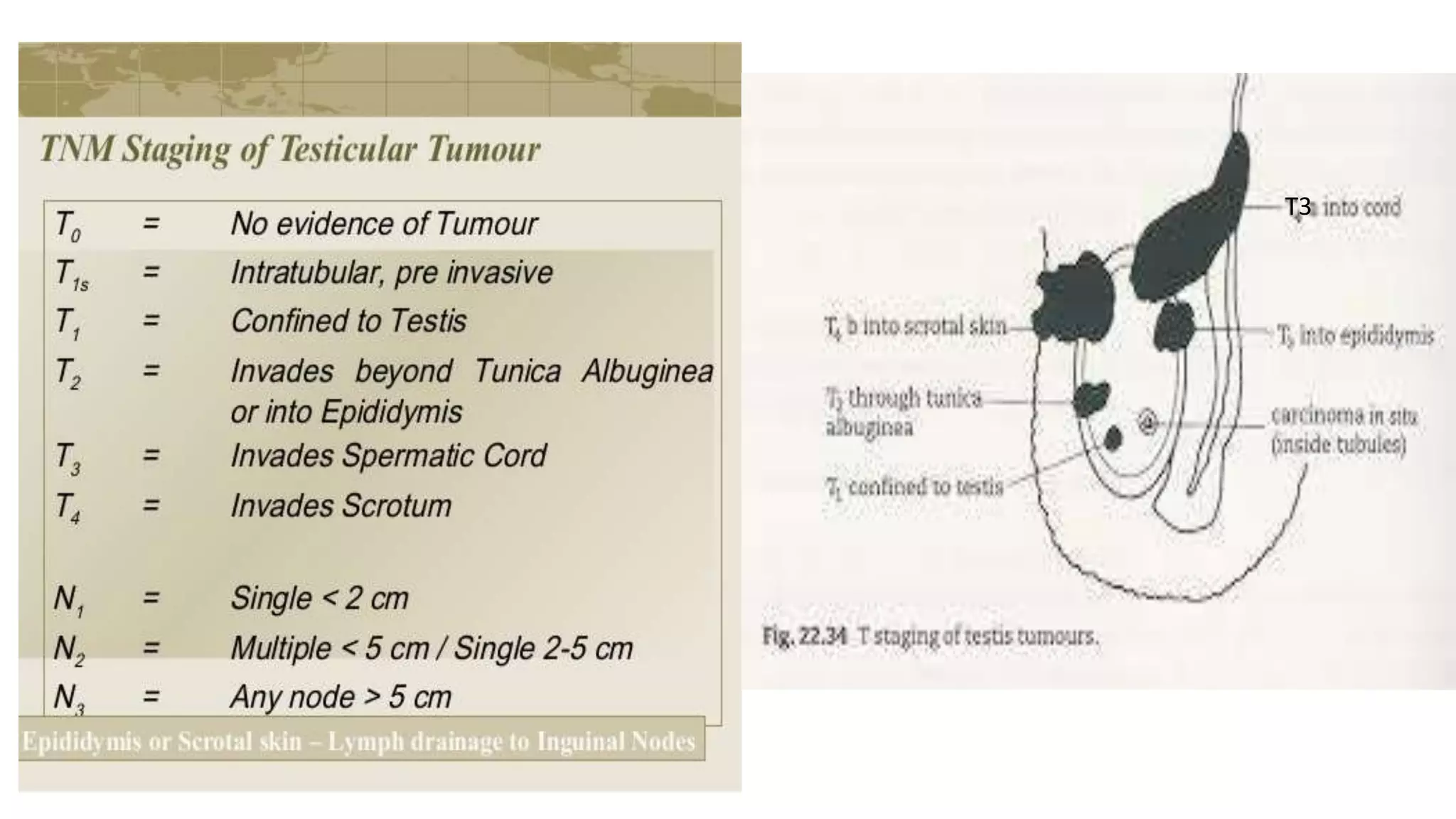 Testicular tumor | PPTX