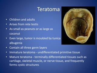 Testicular tumor | PPTX
