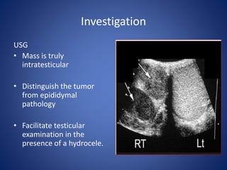 Testicular tumor | PPTX