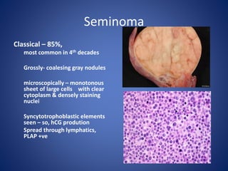 Testicular tumor | PPTX