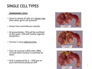 Management of Testicular Tumors | PPT