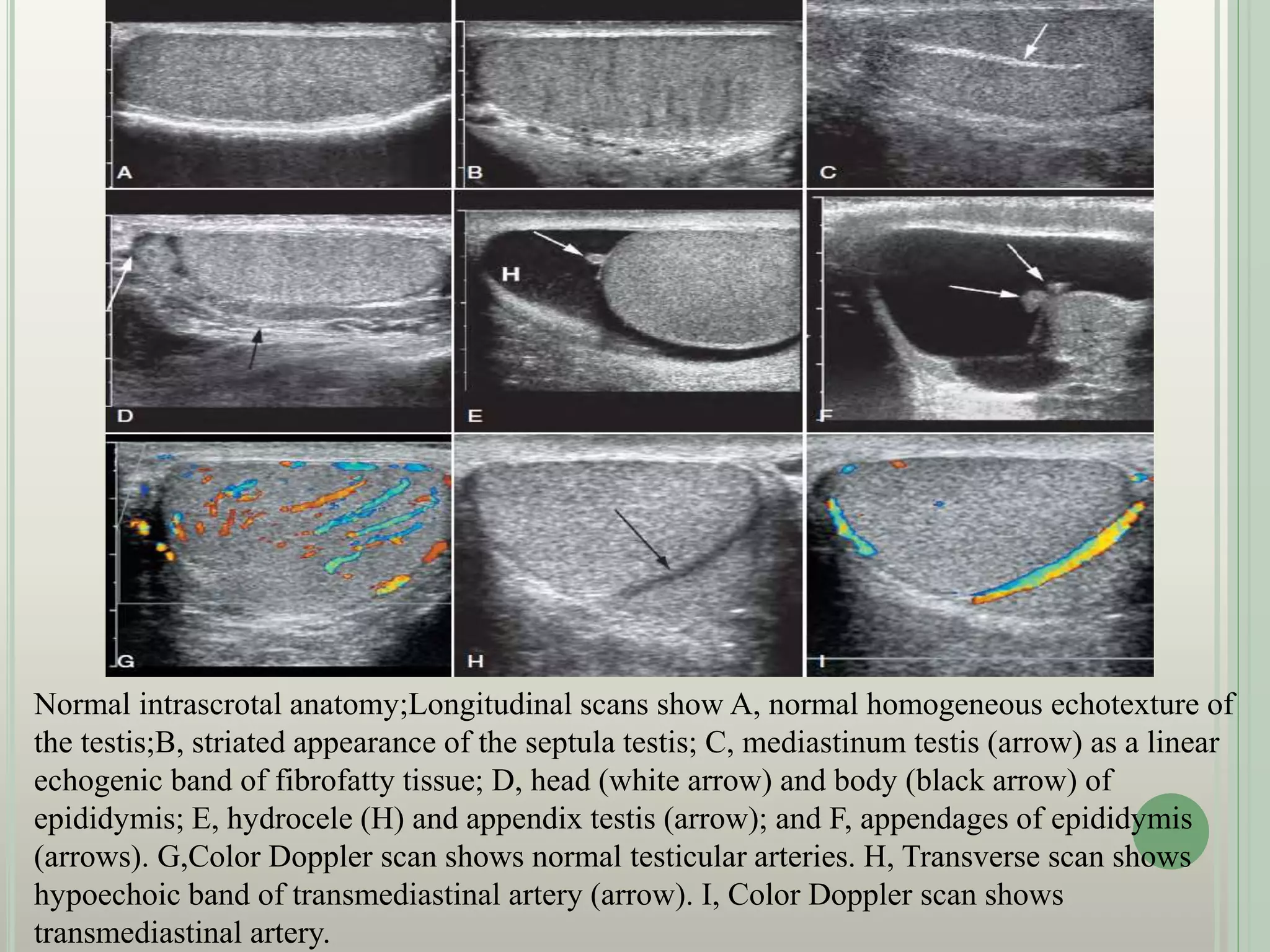 Testicular tumor imaging | PPTX