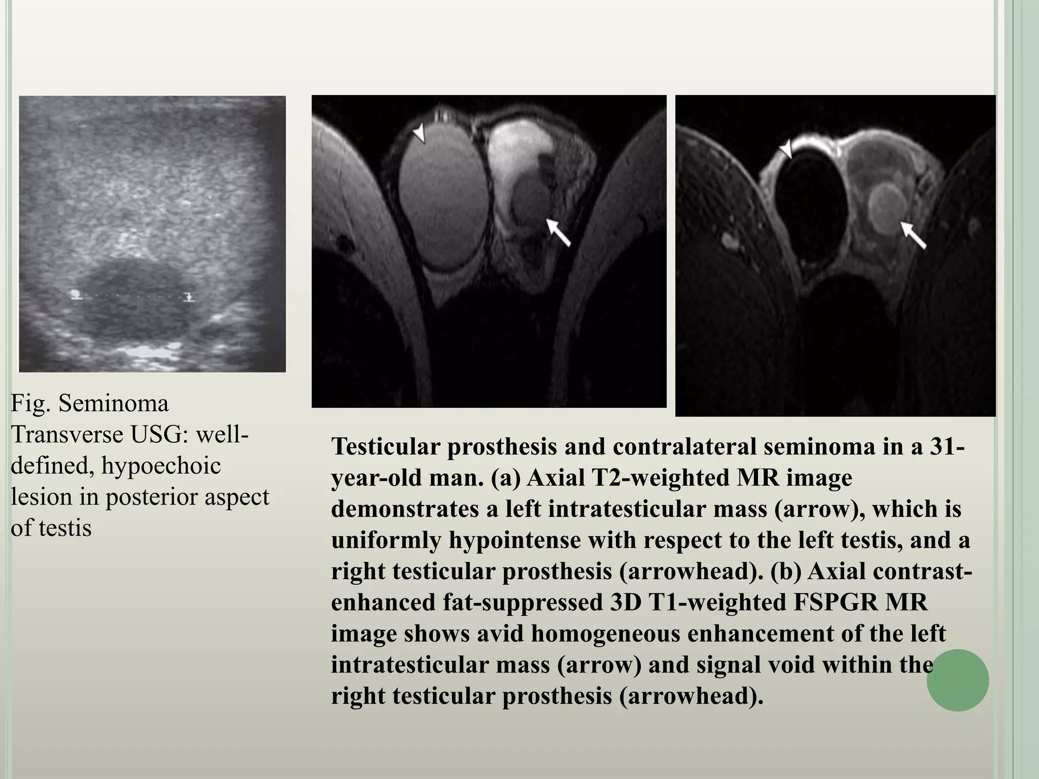 Testicular tumor imaging | PPTX