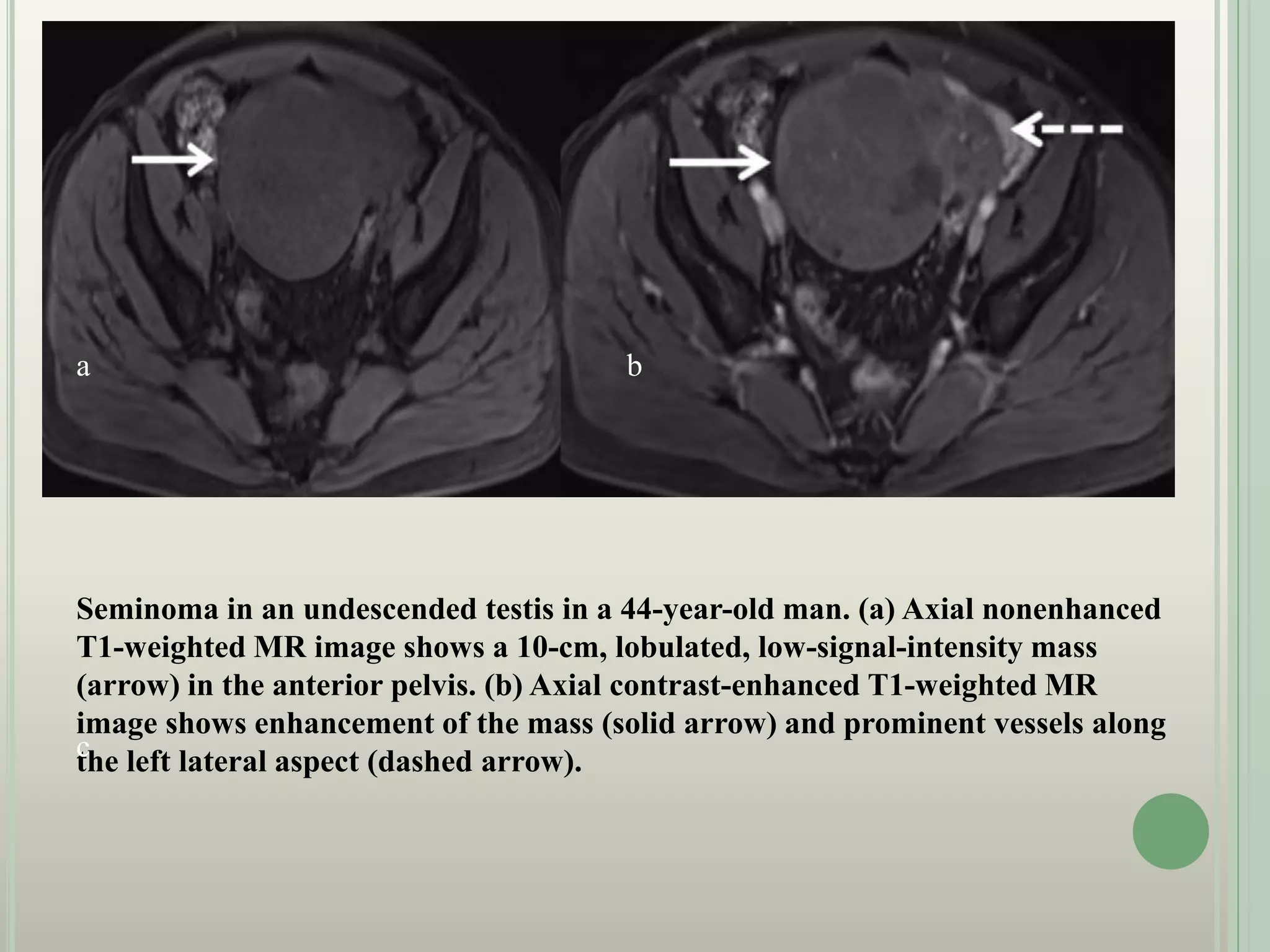 Testicular tumor imaging | PPTX