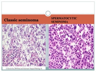 Testicular tumors | PPTX