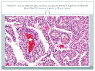Embryonal Carcinoma Of Testis
