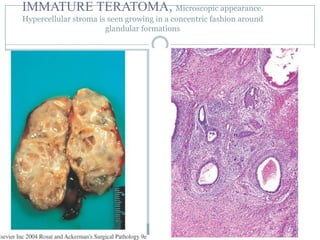 Teratoma Histology