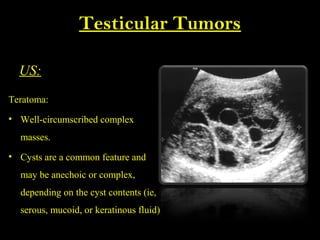 Testicular Teratoma Ultrasound