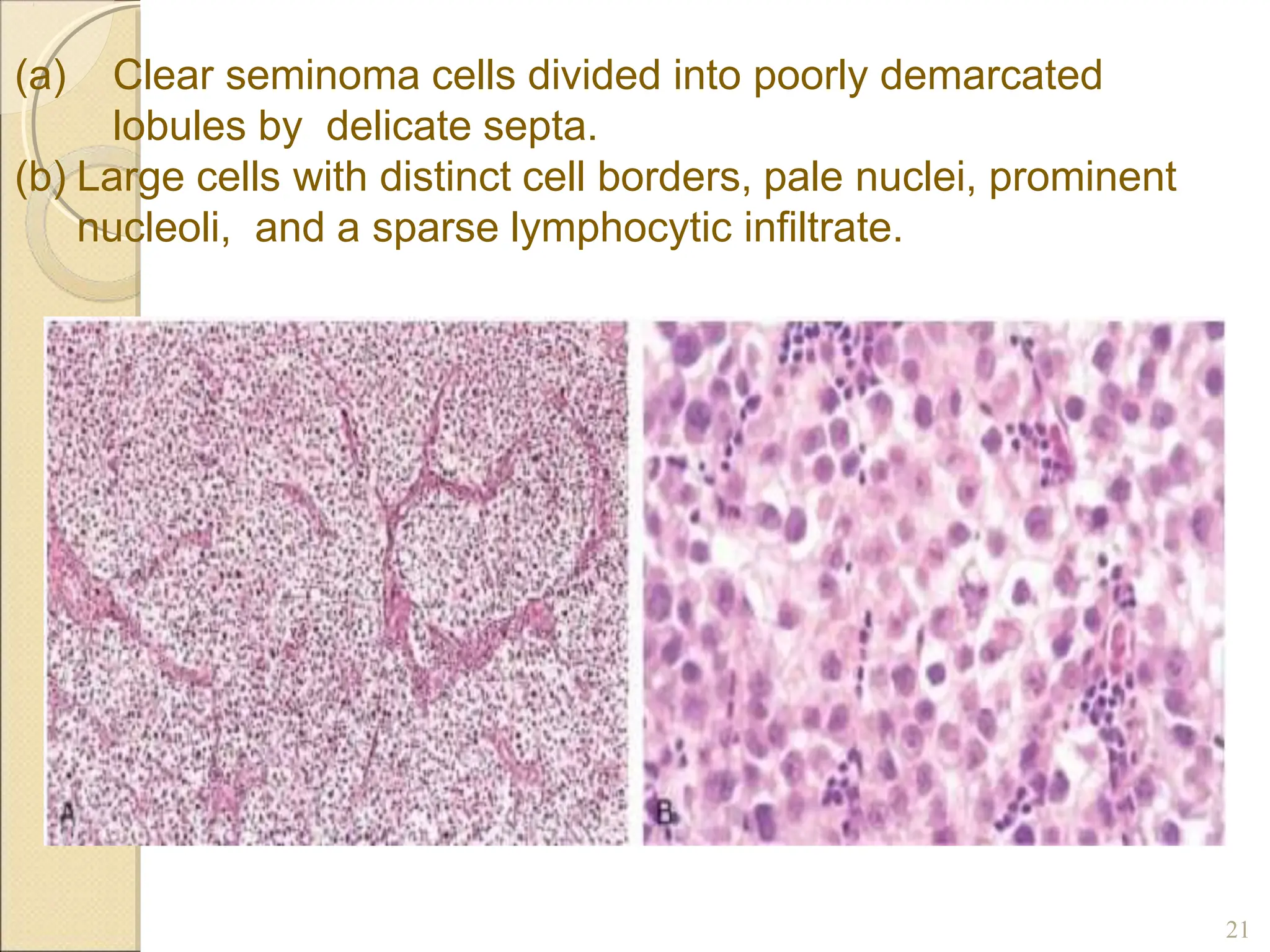 Testicular Tumors Seminar/presentation.pptx