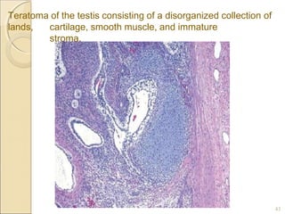 Testicular Tumors Seminar/presentation.pptx
