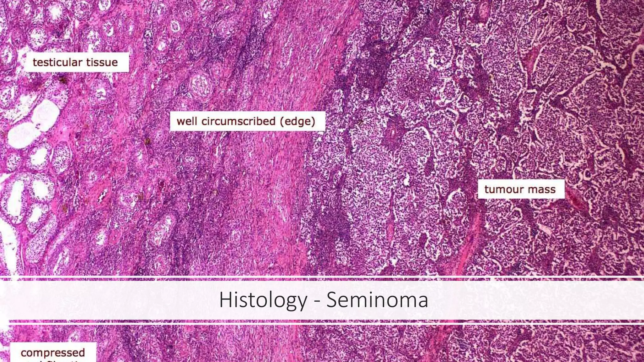 Testicular Tumors Etiopathogenesis Features And Treatment Ppt