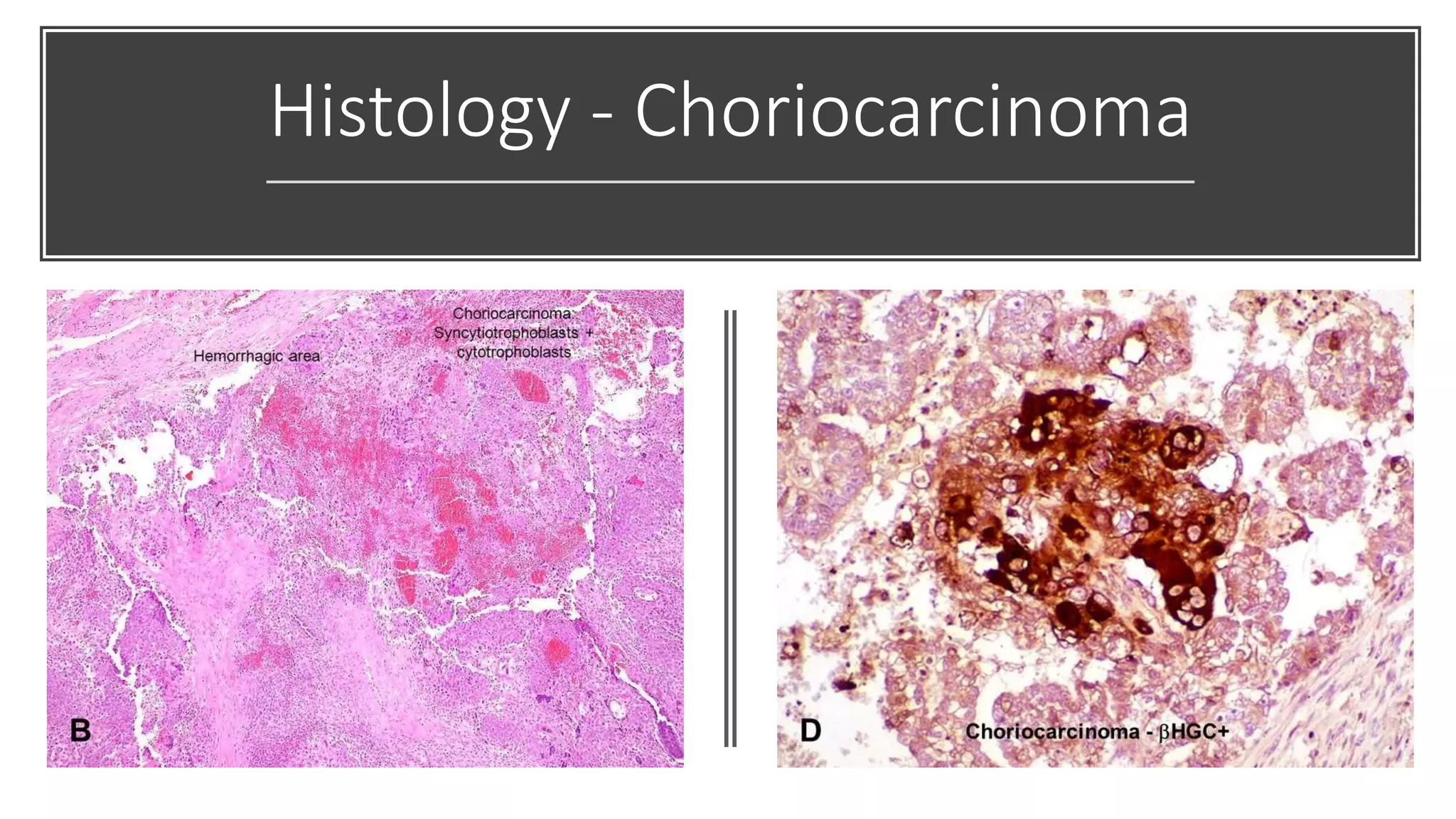 Testicular Tumors Etiopathogenesis Features And Treatment Ppt