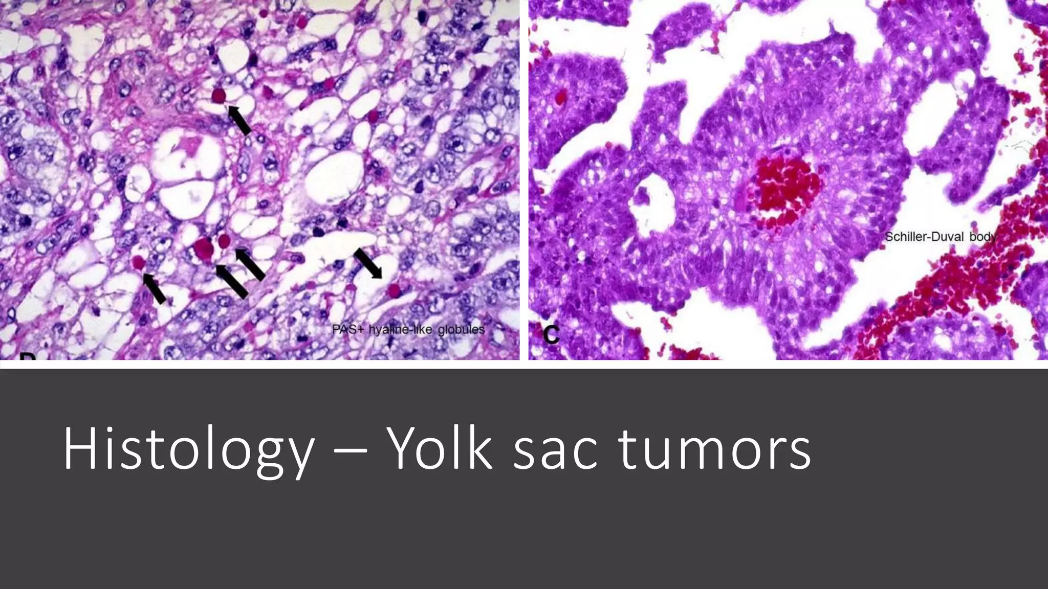 Testicular Tumors Etiopathogenesis Features And Treatment Ppt