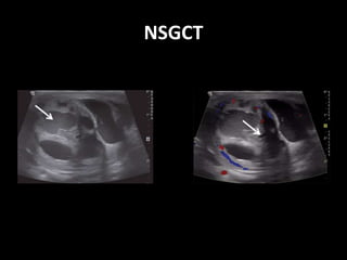 Testicular tumour | PPTX