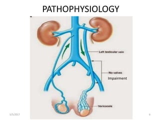 Testicular varicocele and its effects on male infertility | PPTX