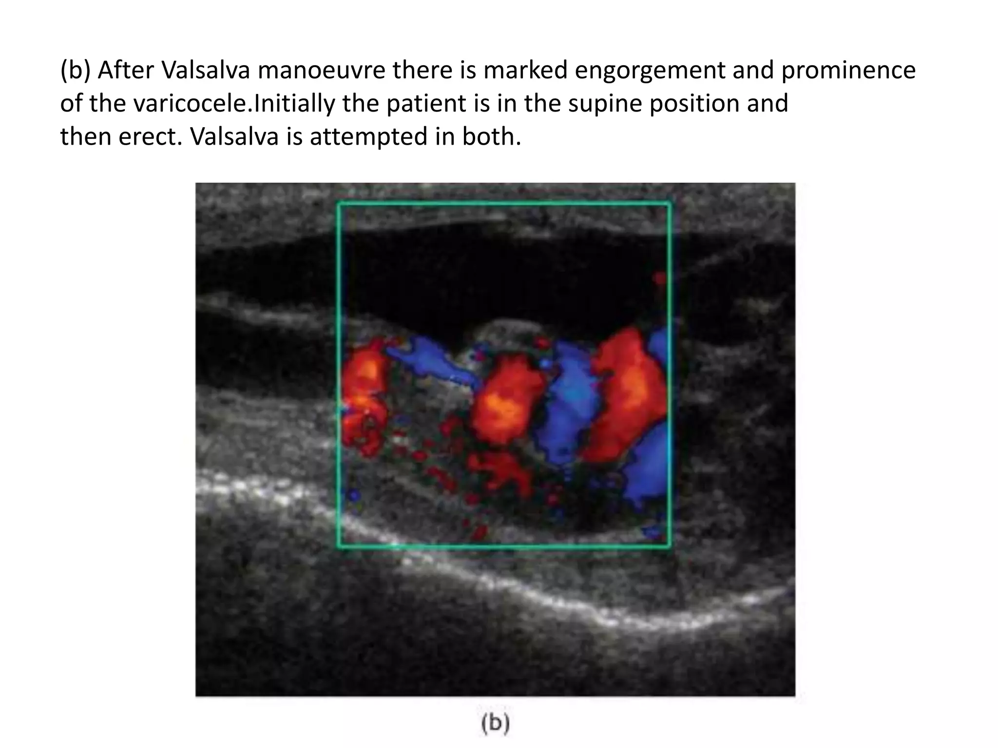 Testicular varicoceles | PPTX