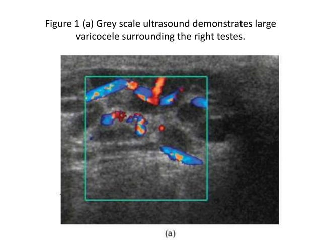Testicular varicoceles | PPTX