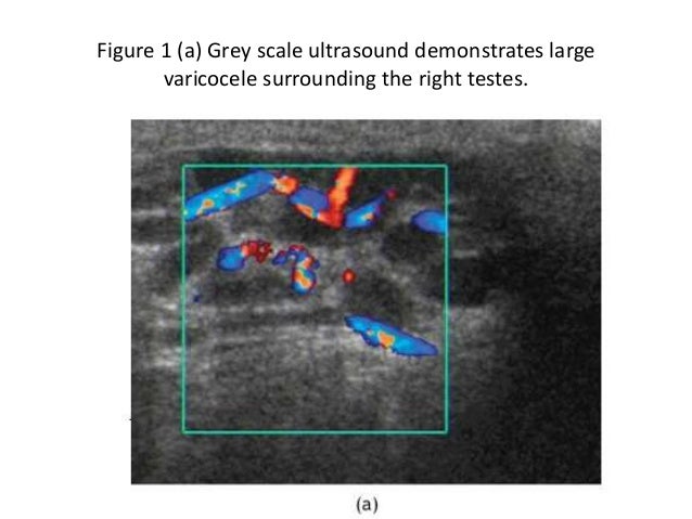 Testicular varicoceles