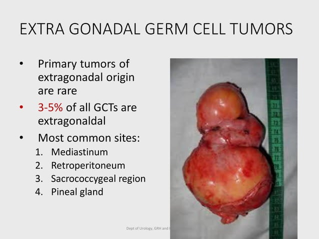 Testis carcinoma- etiopathogenesis | PDF | Infertility | Reproductive ...