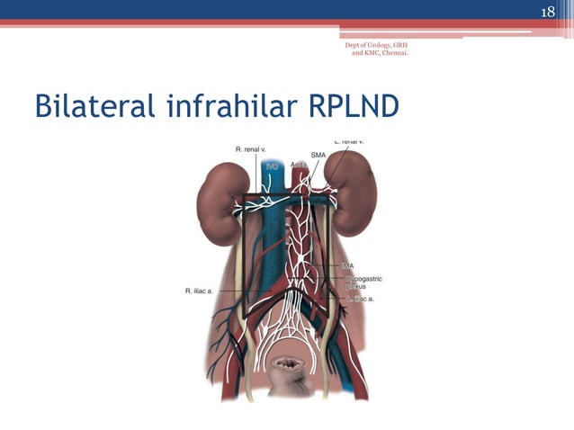 Testis carcinoma- management- lymphatic drainage and rplnd | PDF