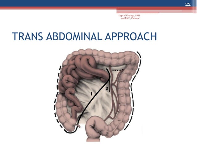Testis carcinoma- management- lymphatic drainage and rplnd | PDF
