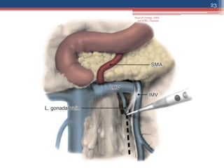 Testis carcinoma- management- lymphatic drainage and rplnd | PDF