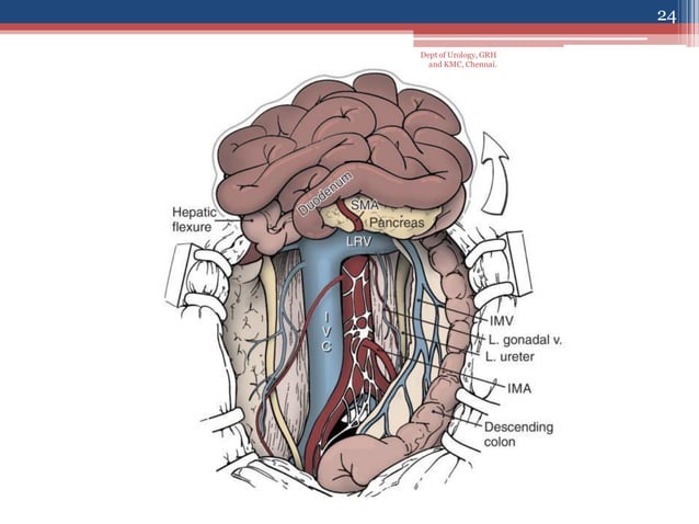 Testis carcinoma- management- lymphatic drainage and rplnd | PDF