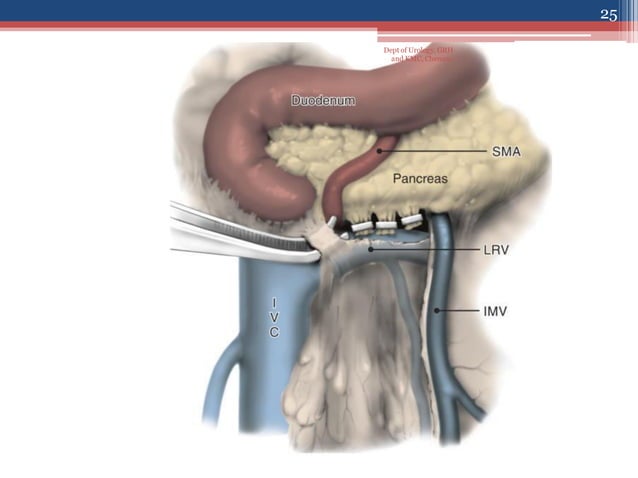 Testis carcinoma- management- lymphatic drainage and rplnd | PDF