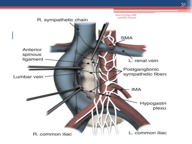 Testis carcinoma- management- lymphatic drainage and rplnd | PDF