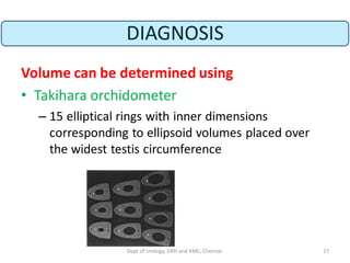 Testis varicocele | PDF