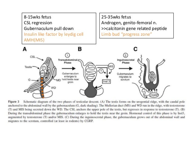 Testis Torsion In Undescended Testis