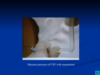 Test Of Cerebrospinal Fluid And Serous Membrance Effusion | PPT