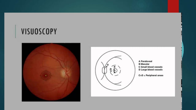 TESTS FOR GRADE OF BINOCULAR VISION AND SENSORY.pptx