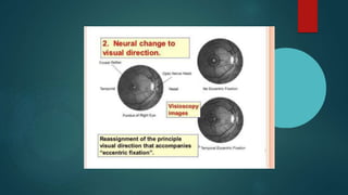 TESTS FOR GRADE OF BINOCULAR VISION AND SENSORY.pptx