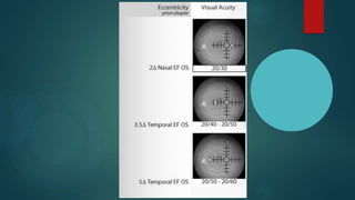 TESTS FOR GRADE OF BINOCULAR VISION AND SENSORY.pptx