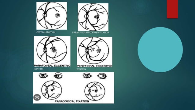 TESTS FOR GRADE OF BINOCULAR VISION AND SENSORY.pptx