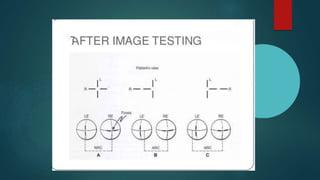 TESTS FOR GRADE OF BINOCULAR VISION AND SENSORY.pptx