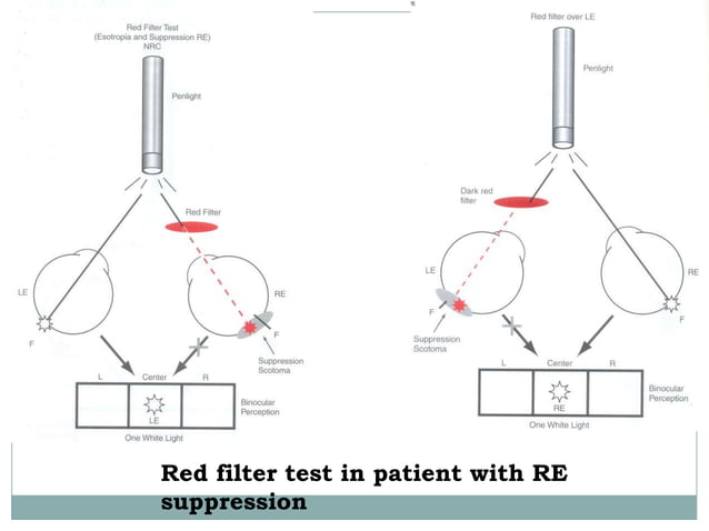 Tests of binocularity | PPTX
