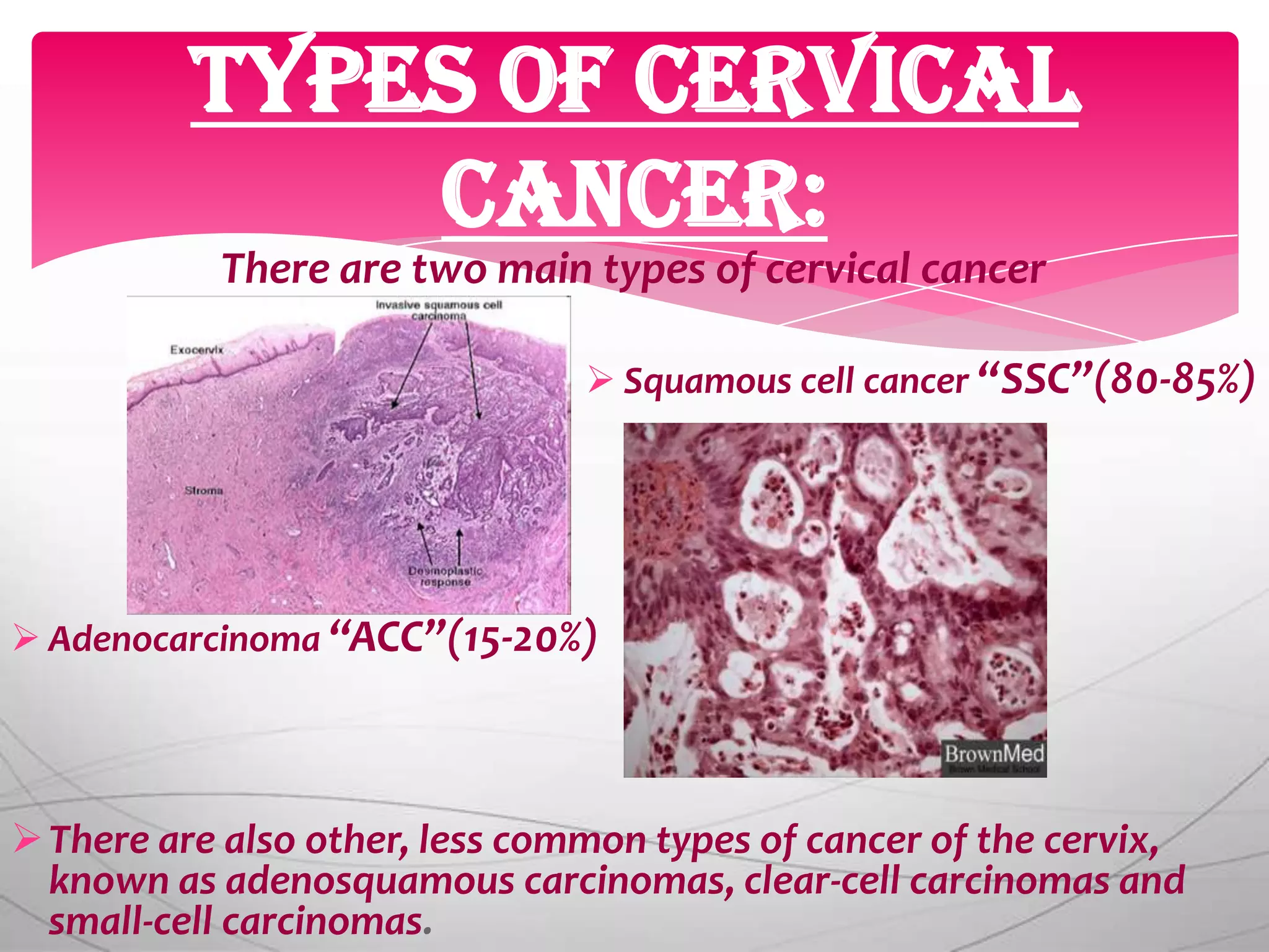 cervical cancer ,,, 4 college students.. | PPTX