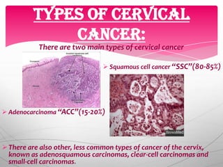 cervical cancer ,,, 4 college students.. | PPTX