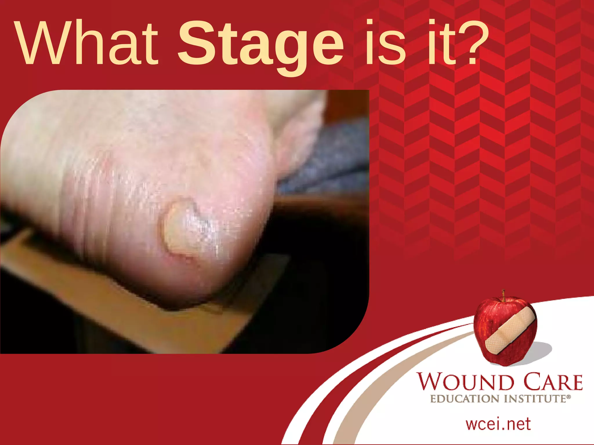 Test Your Pressure Injury Staging Skills - Updated for 2016 | PDF