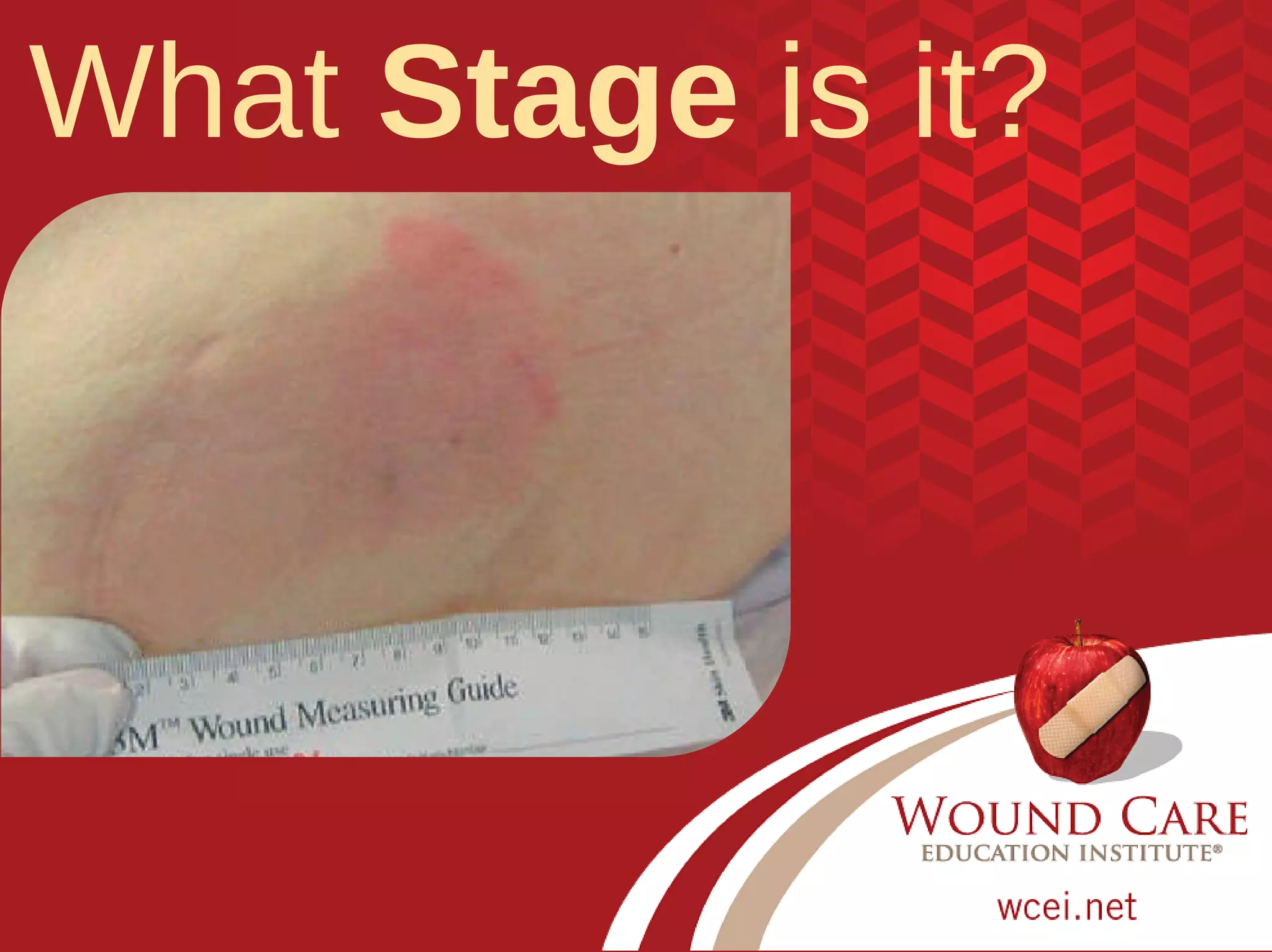 Test Your Pressure Injury Staging Skills - Updated for 2016 | PDF