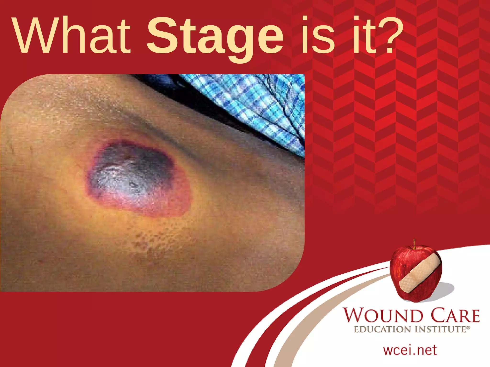 Test Your Pressure Injury Staging Skills - Updated for 2016 | PDF