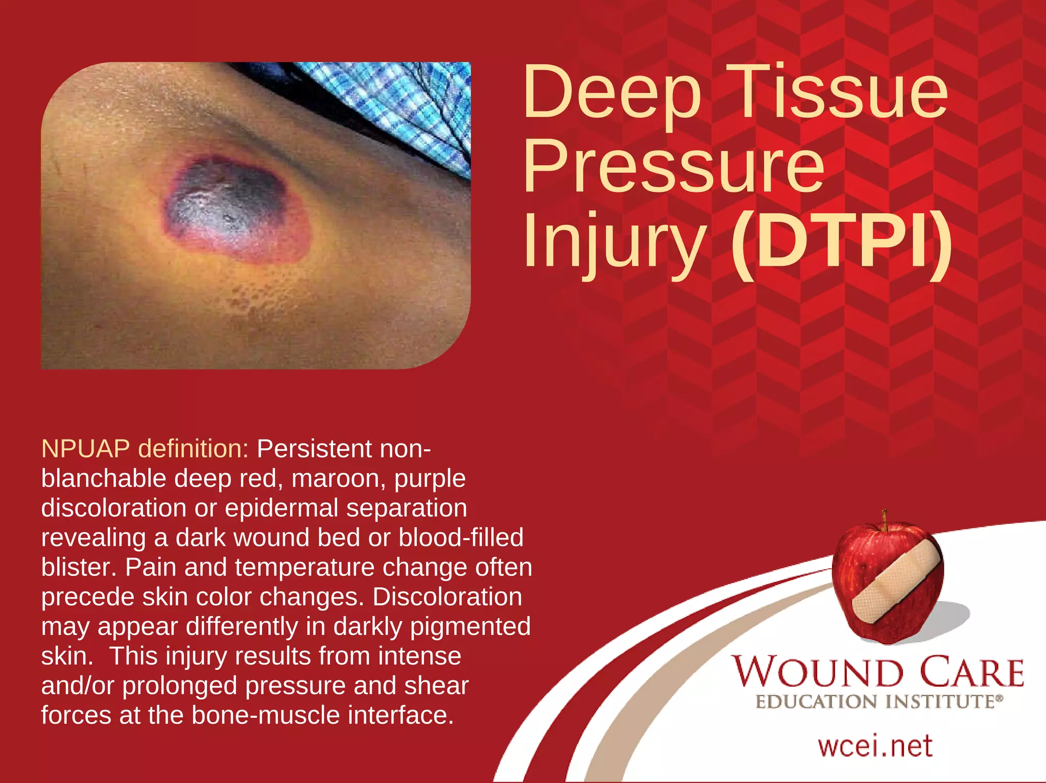 Test Your Pressure Injury Staging Skills - Updated for 2016 | PDF